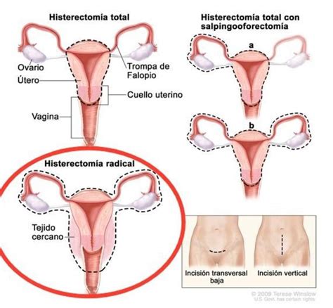 Que es la Histerectomía Wiki TRANS AMINO Amino