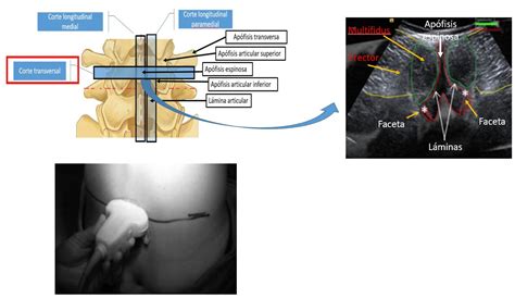 Ecograf A De La Columna Vertebral Lumbar Dolopedia