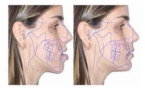 Cirurgia ortognática saiba tudo sobre o procedimento Codental Blog