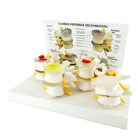 Buy Iksvmsis Human Model Spine Lumbar Vertebrae Models Set 4 Stage