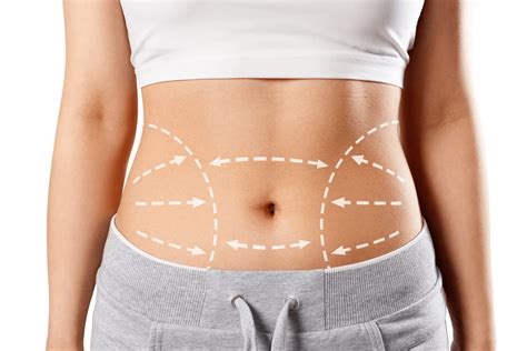 Abdominoplastia Cómo conseguir un abdomen plano Diario Murcia