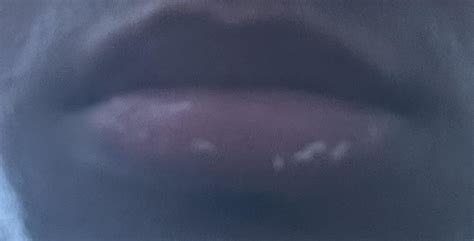 Peeling Lips Super Dry Lips R Accutane