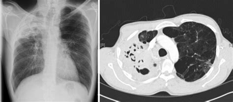 A Chest Radiograph And Ct Scan Of A Patient With Copd Showing