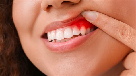Dicas Caseiras Para Gengiva Inflamada Blog Do Portal Educa O