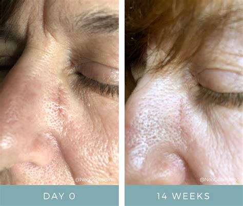 Mohs Surgery NeoGenesis Pro