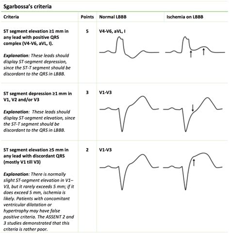 Left Bundle Branch Block LBBB In Acute Myocardial Infarction Utility