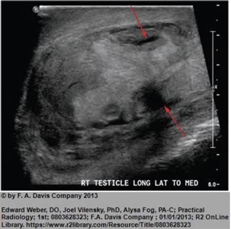 Testicular Pathology Flashcards Quizlet