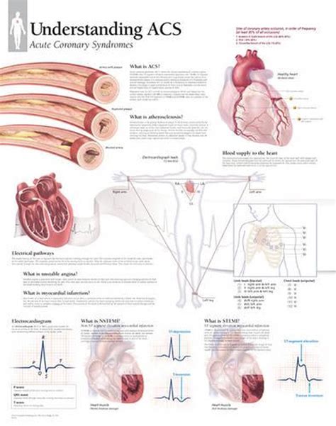 Understanding ACS Acute Coronary Syndrome Laminated Poster By