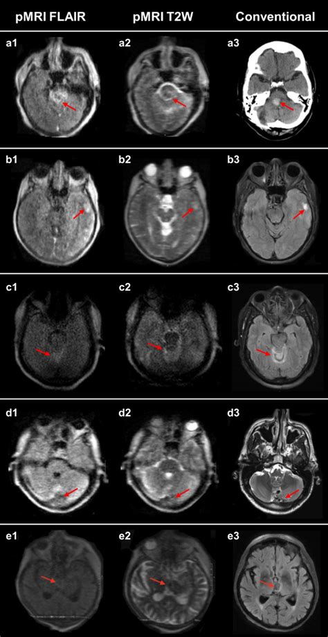 Portable Bedside Low Field Magnetic Resonance Imaging For Evaluation