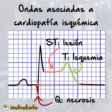 Diagnóstico electrocardiográfico del Infarto Agudo al Miocardio IAM