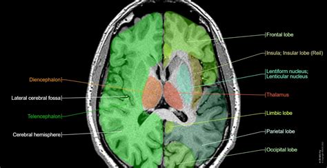 Brain Mri 3d Normal Anatomy E Anatomy