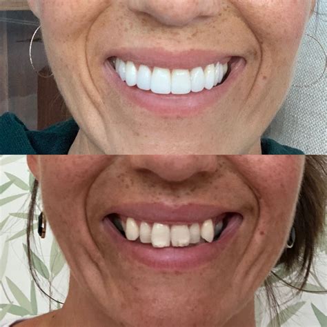 Best Dental Implants Implant Dentist Teeth Whiting At Home Veneers