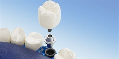 Implantes Dentales Y Coronas Embellecen Tu Sonrisa