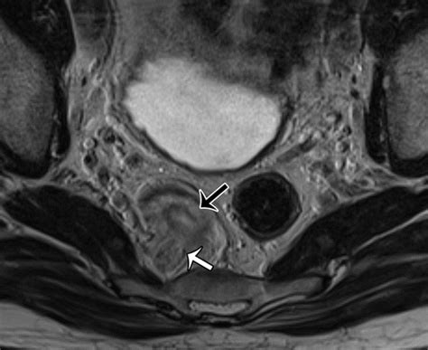 MRI Of Tumors And Tumor Mimics In The Female Pelvis Anatomic Pelvic