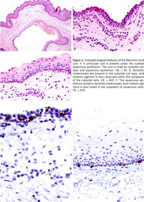 Figure From The First Reported Case Of Pigmented Bartholin Duct Cyst