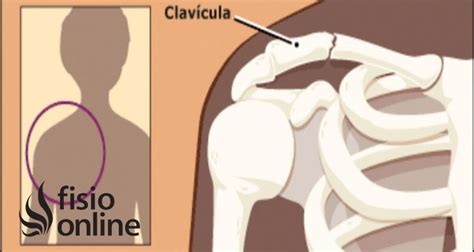 Fractura de clavícula Qué es qué estructuras afecta síntomas