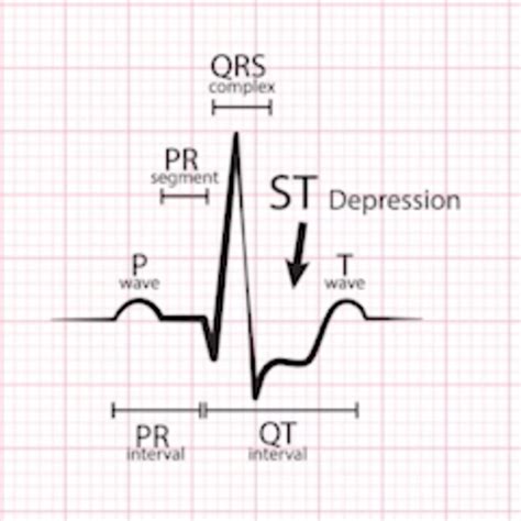 Acute Coronary Syndrome Acs Flashcards Quizlet