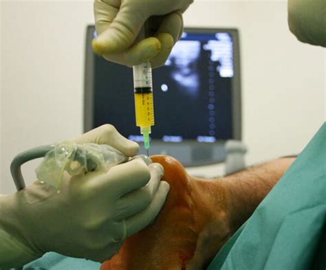 Infiltraciones en el pie Para qué se usan las infiltraciones en podología