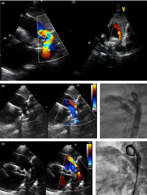 Patent Ductus Arteriosus Echo