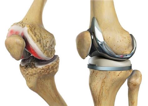 Cirurgia De Joelho Dr Pedro Giglio