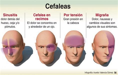 Conoces las diferencias entre Cefalea Tensional y Migrañas