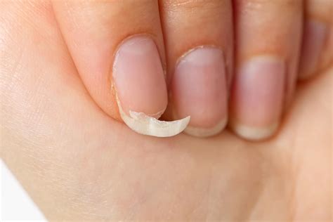 Ongle cassé 5 astuces infaillibles pour une réparation express et