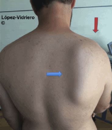 Paciente con luxación acromioclavicular grado iii en el hombro derecho