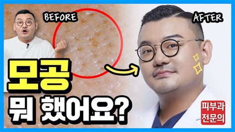 청담 피부과원장의 모공 줄이는 방법 쫀쫀한 모공만드는 시술 총정리 YouTube