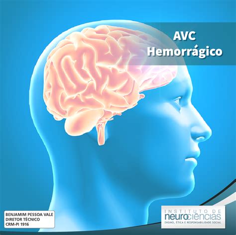 AVC hemorrágico INSTITUTO DE NEUROCIÊNCIAS