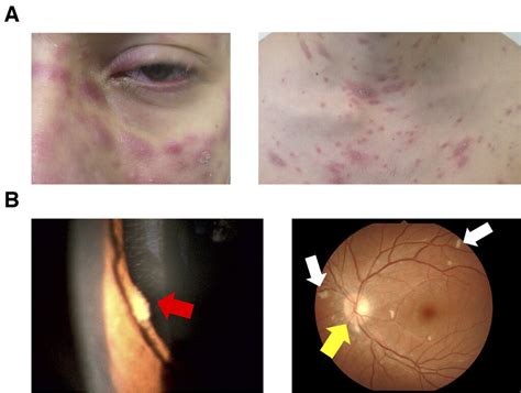 Skin Lesions Of Disseminated Histoplasmosis Resembling Kaposis Sarcoma