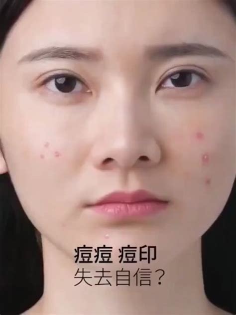 Effective Quickly Remove Pimples Remover Acne Cream Fades Acne Marks
