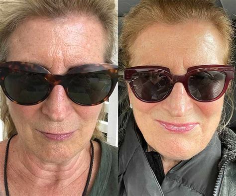 Red Light Therapy Before And After SolaWave Double Menton Blue Light
