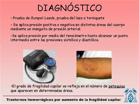 TRASTORNOS HEMORRGICOS POR AUMENTO DE LA FRAGILIDAD CAPILAR