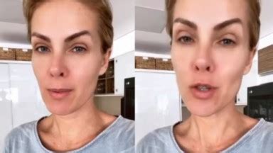 Ana Hickmann Aparece Hematoma No Bra O Ap S Viol Ncia Dom Stica