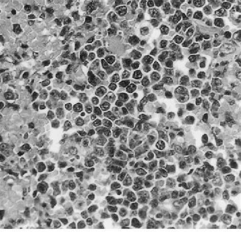 Photomicrograph Of The Ileum Tumor Showing Diffuse Proliferation Of