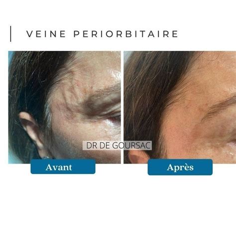 Traitement anti rides Avant et après Multiesthetique fr