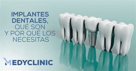 Qué son los implantes dentales y por qué los necesitas