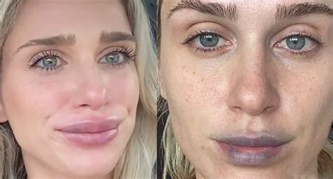 Tiktoker faz preenchimento labial e resultado é desastroso O Segredo