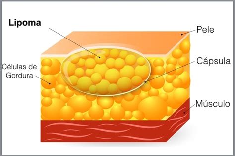 Lipoma O que é Lipoma Causas Sintomas e Tratamento