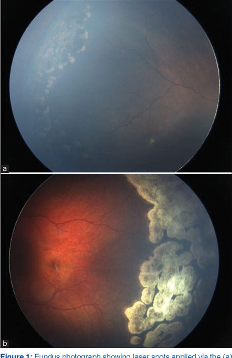 Figure From Transscleral Vs Transpupillary Diode Laser