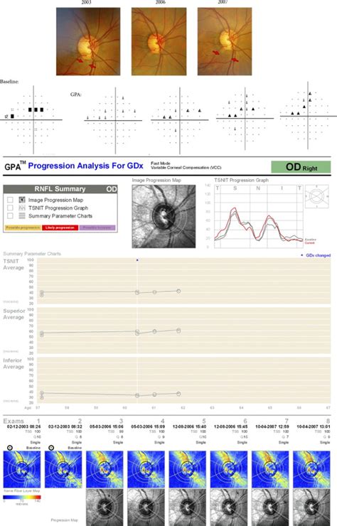Agreement For Detecting Glaucoma Progression With The Gdx Guided