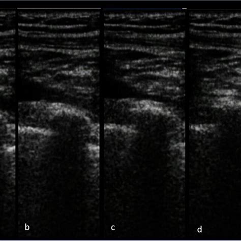 Ultrasound Imaging Of The Axillary Vein Size Variation During Tidal