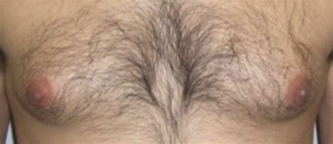 Como saber si tengo ginecomastia o grasa pseudoginecomastia Dr Terrén
