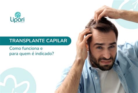 Transplante capilar para quem é indicado