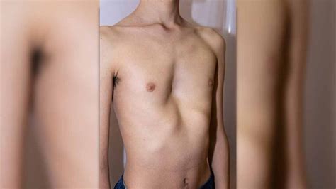 Pectus Excavatum O T Rax Excavado Una Deformidad Cong Nita De La Pared
