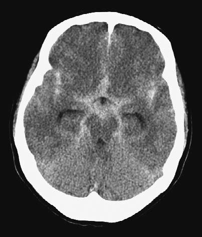 Axial Computed Tomography Scan Showing Diffuse Subarachnoid Hemorrhage
