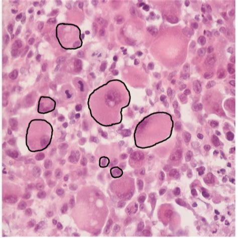 Neoplasia Flashcards Quizlet