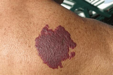 Port Wine Birthmark On Back