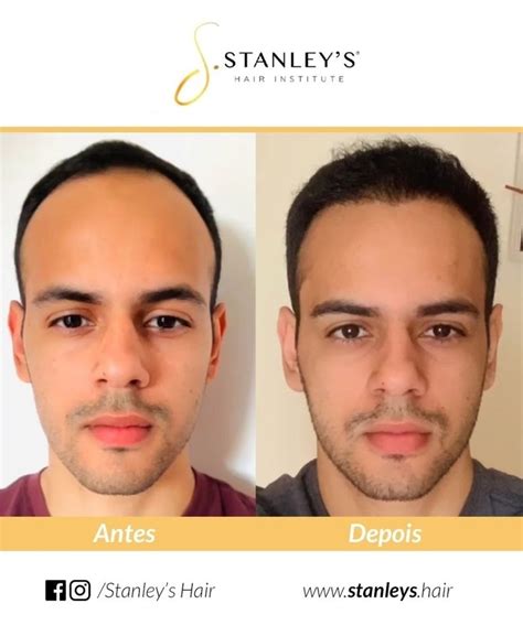 Antes e depois Transplante capilar Capilar Felipe augusto Evolução