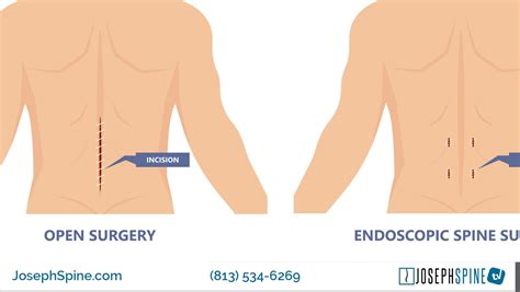 Scoliosis Surgery Scar